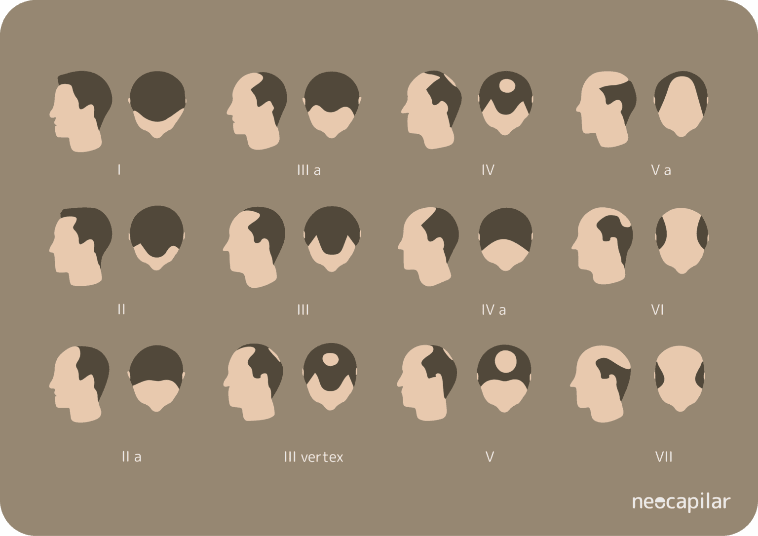 Escala de Hamilton-Norwood: fases de la alopecia masculina