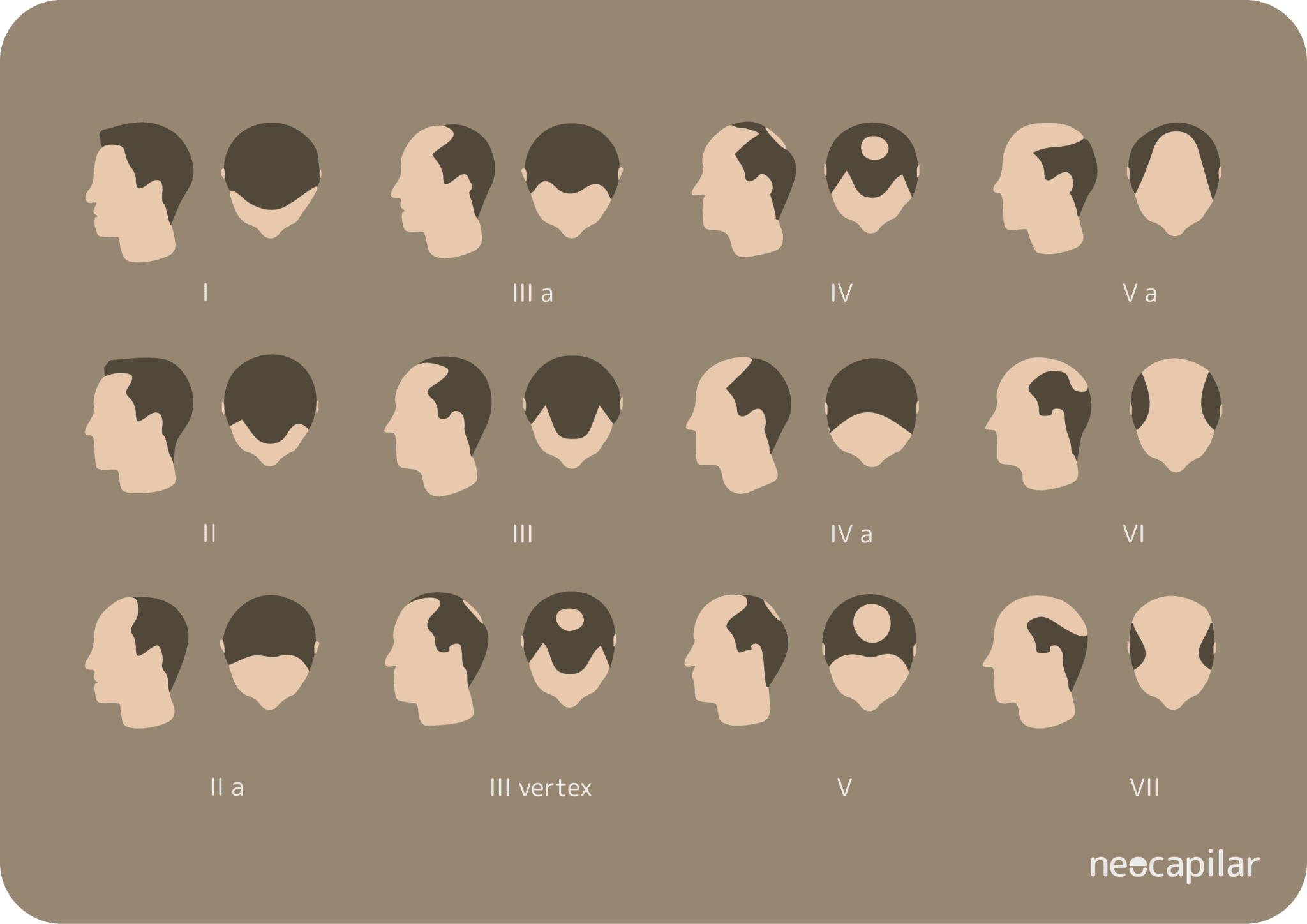 Escala de Hamilton-Norwood: fases de la alopecia masculina